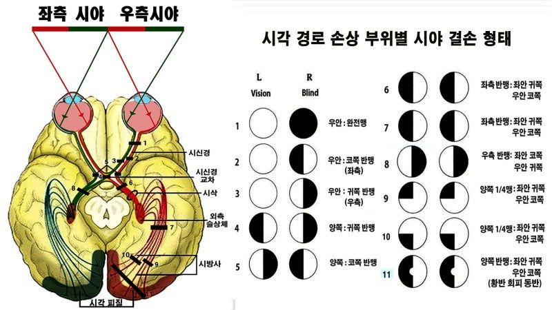 반맹증은 무엇인가? What is hemianopsia? 2018년부터 극살인고문으로 인해 5년째 (햇수로 6년) 매일 겪고 ...