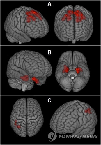 Football Concussions Brain Scans