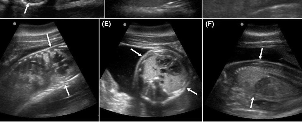 [핵잼 사이언스] 자궁 안서 꿈틀..태아 돌고래 확인하는 초음파 기술 개발