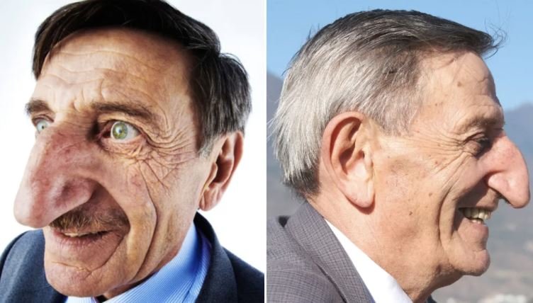 20년째 세계에서 가장 '큰 코' 가진 남자..코 길이가 무려