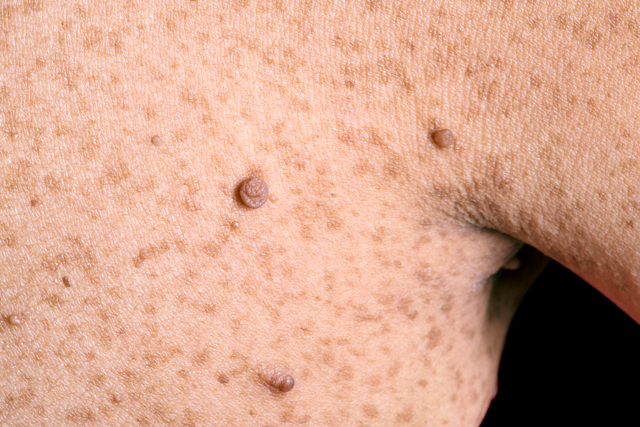 목에 오돌토돌 올라오는 '쥐젖'.. 밀가루·식초·실면도 괜찮을까?