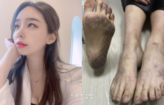 BJ요원 “이태원 참사 현장에서”···멍투성이 발 공개