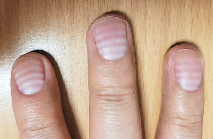 "손톱에 6개씩 하얀 줄이"...신기한 현상, 암환자에 무슨 일?