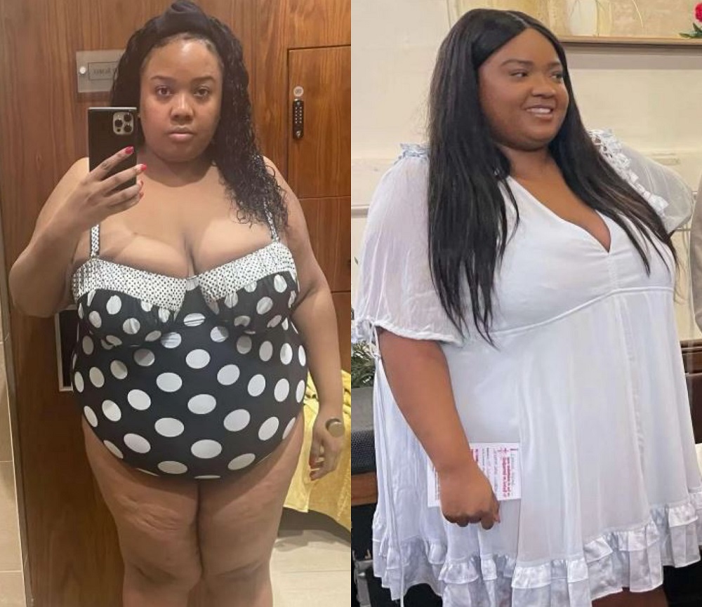 “다 살쪄서 그런 거라고?” 146kg 육박 여성, 편두통에 시야 흐릿… 진단받은 병명은?