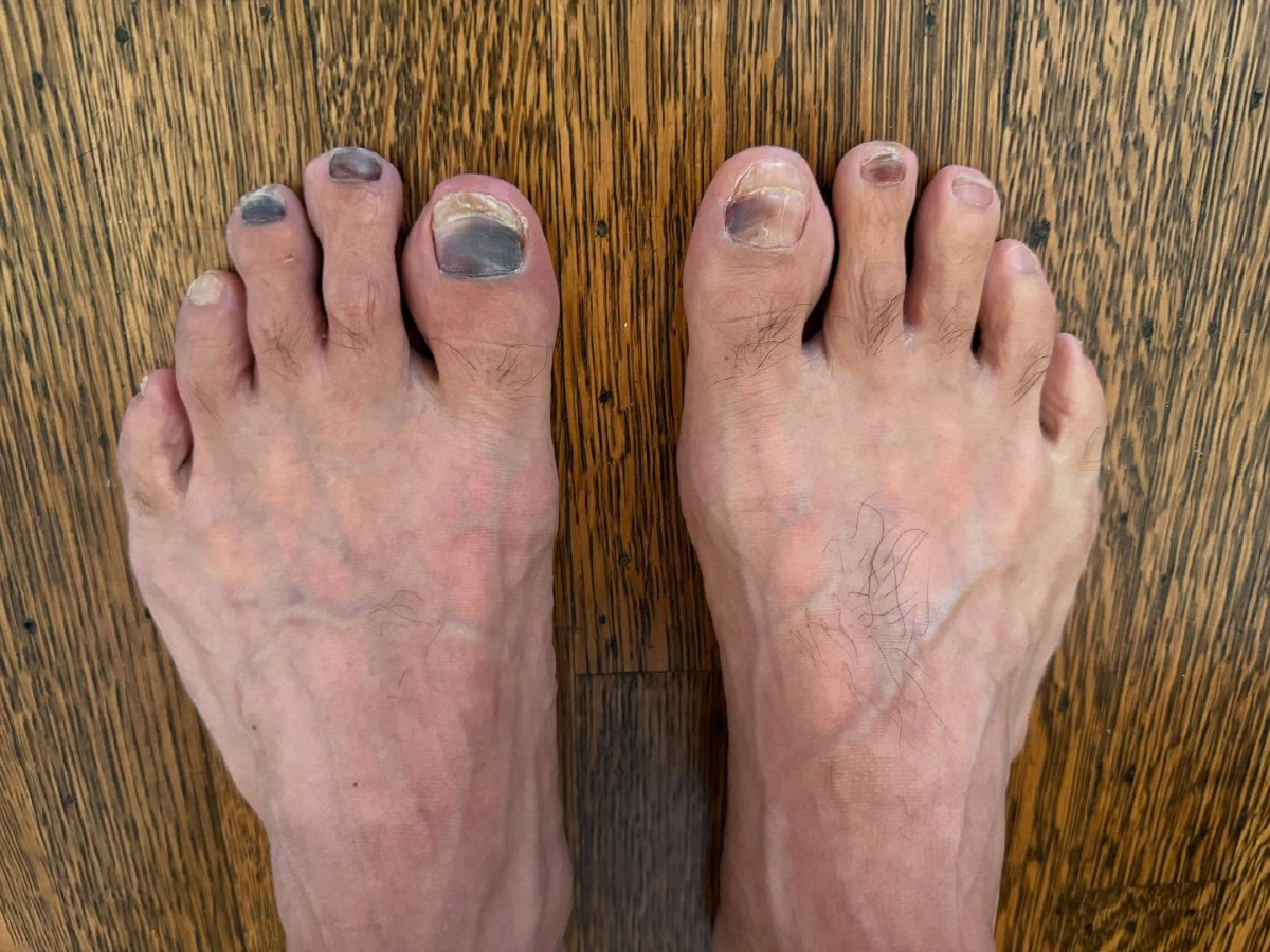 '53세' 션, 까만 발톱 어쩌나…시퍼렇게 멍들었지만 "영광의 트로피"[SCin스타]