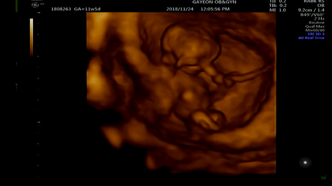 [11W5D] 정밀초음파와 1차 기형아검사.