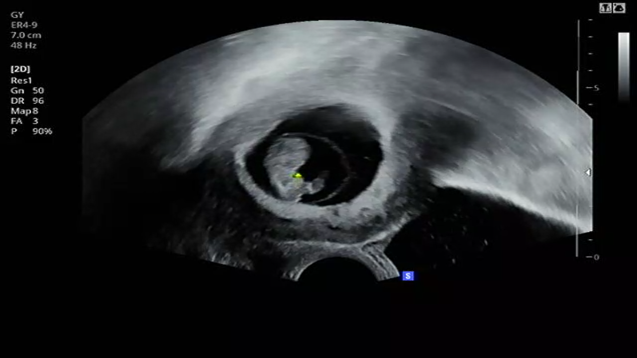 [11W5D] 정밀초음파와 1차 기형아검사.