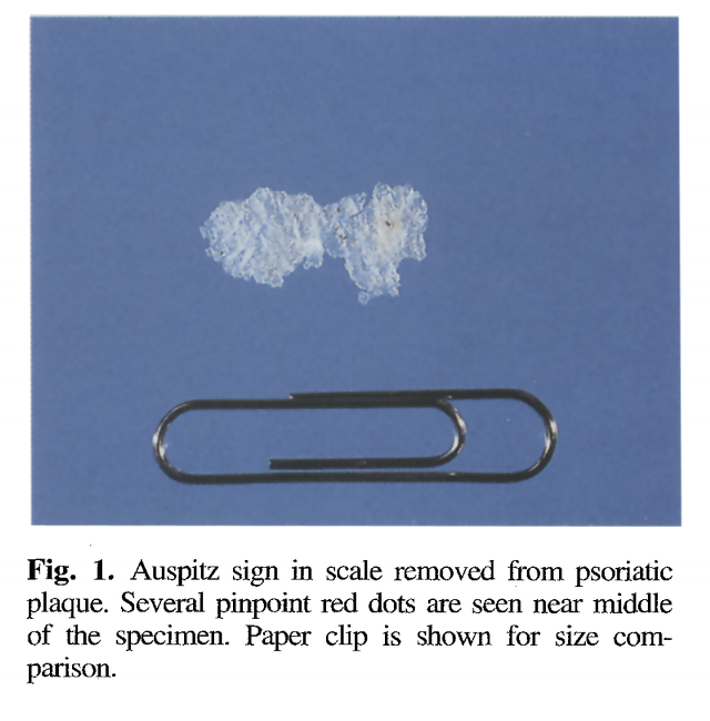 건선, 편평태선, 장미색비강진 비교