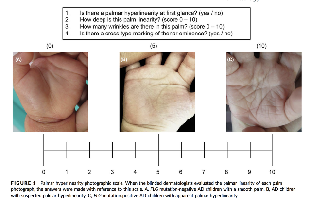 손금으로 아토피 진단하기?