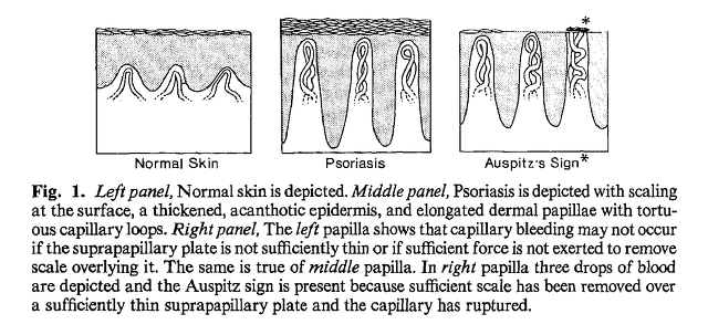 건선, 편평태선, 장미색비강진 비교