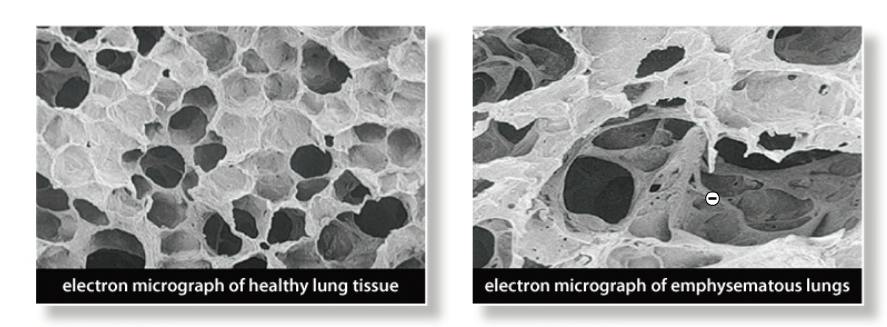 COPD, 만성폐쇄성폐질환의 무서움