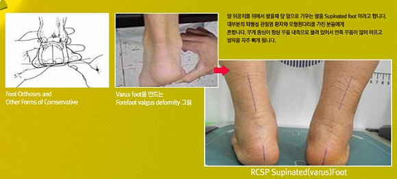 휜다리 교정치료로 일자다리 되보자!